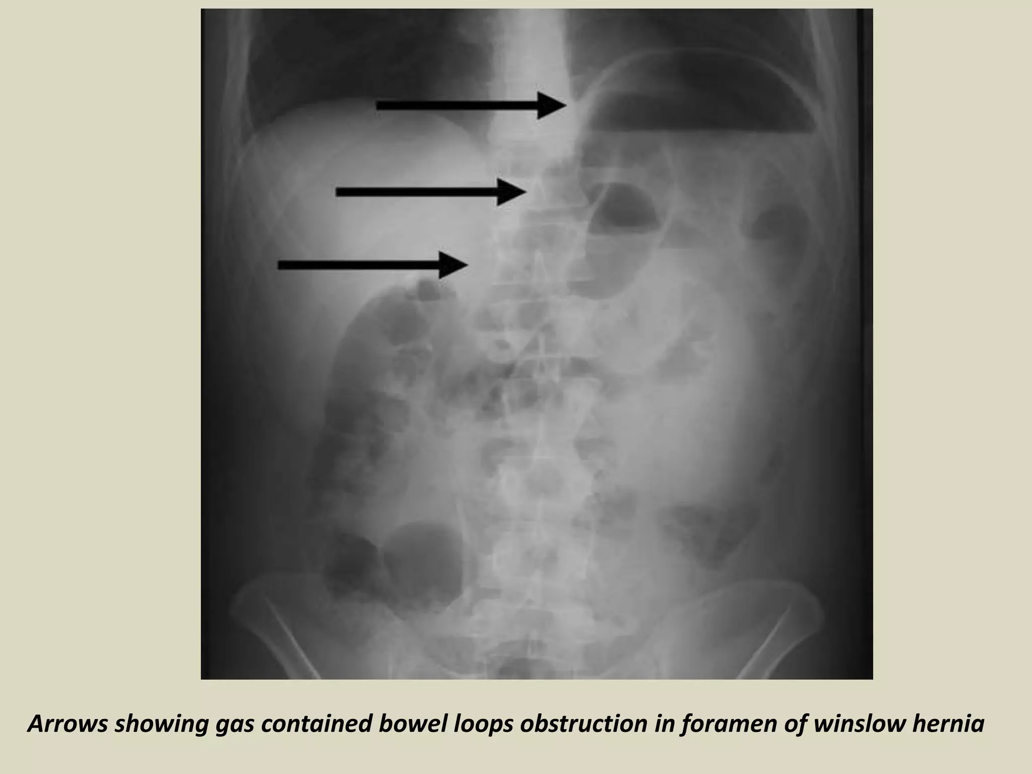 Presentation1, radiological imaging of internal abdominal hernia. | PPTX