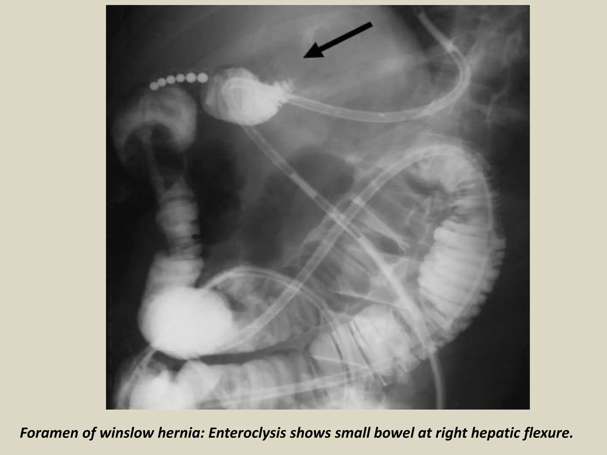 Presentation1, radiological imaging of internal abdominal hernia. | PPTX
