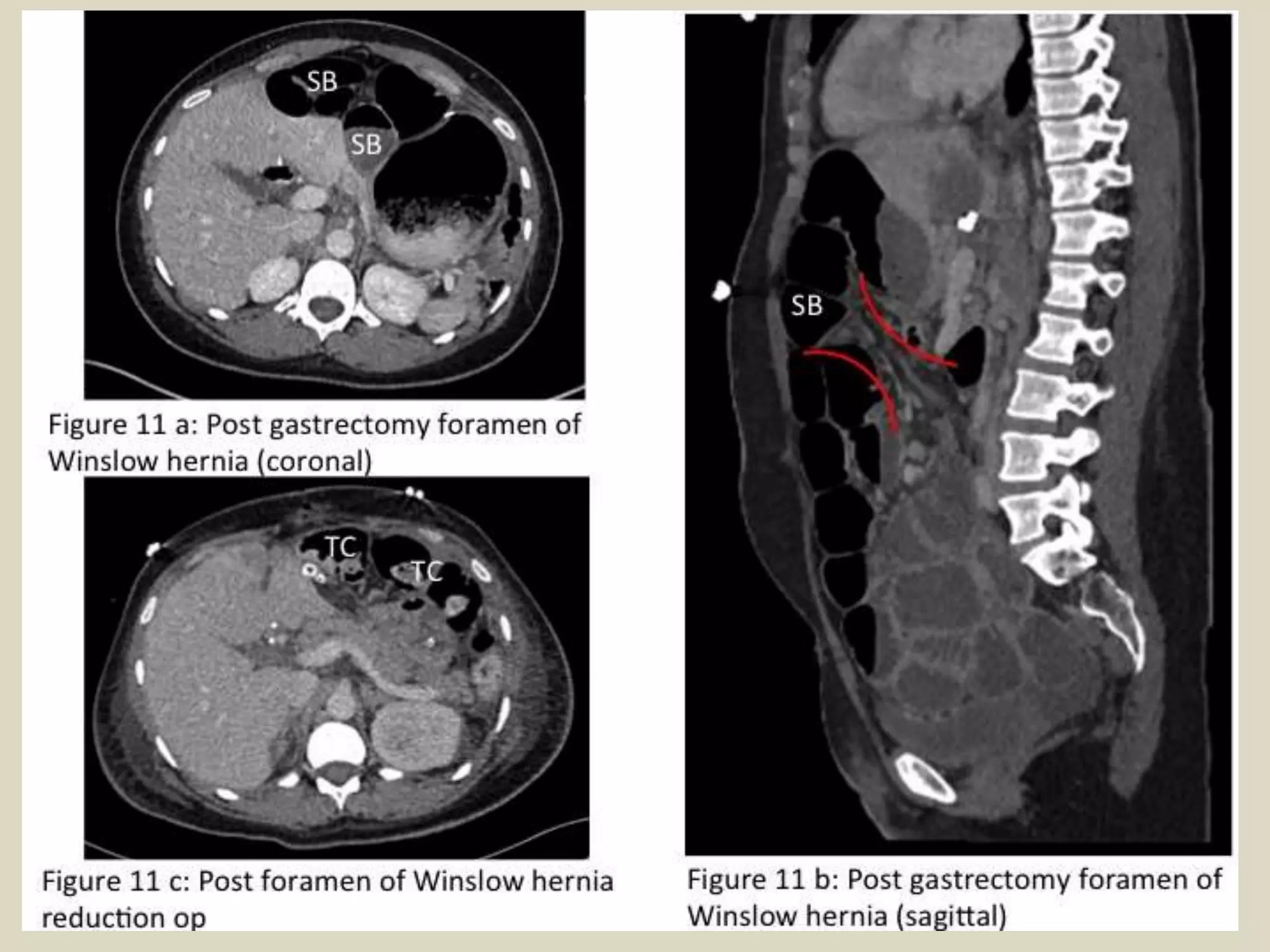 Presentation1, radiological imaging of internal abdominal hernia. | PPTX