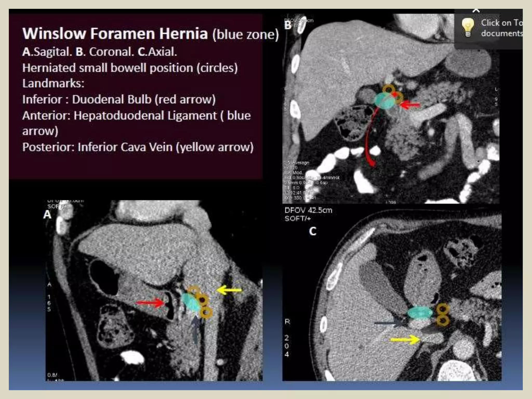 Presentation1, radiological imaging of internal abdominal hernia. | PPTX