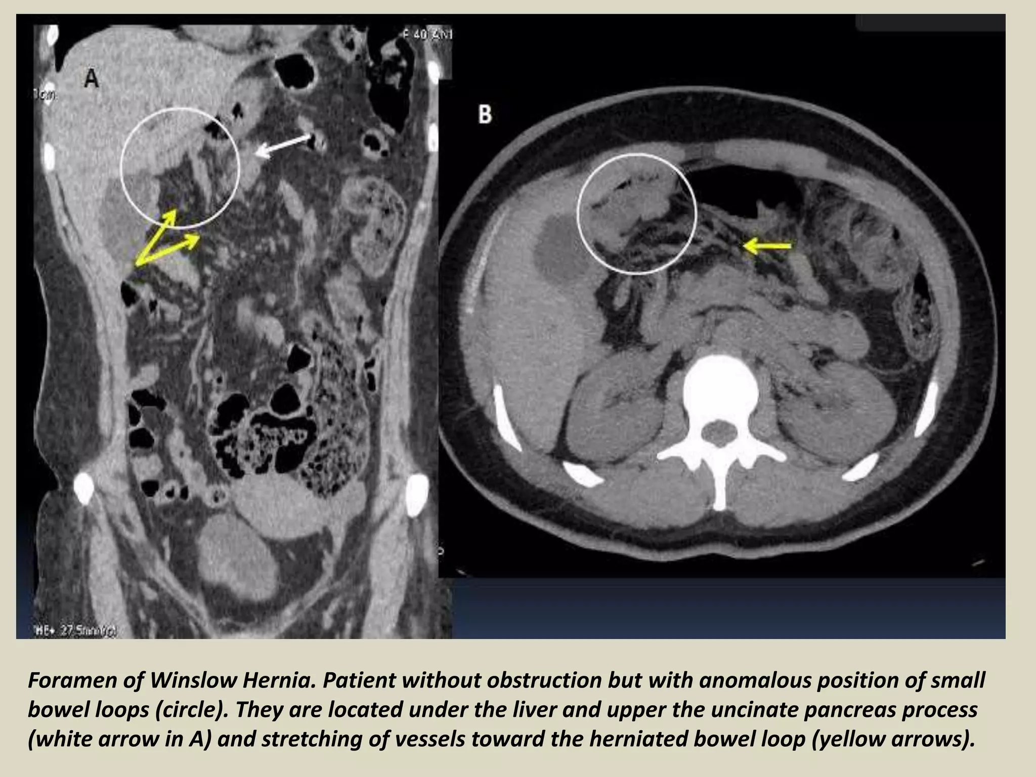 Presentation1, radiological imaging of internal abdominal hernia. | PPTX