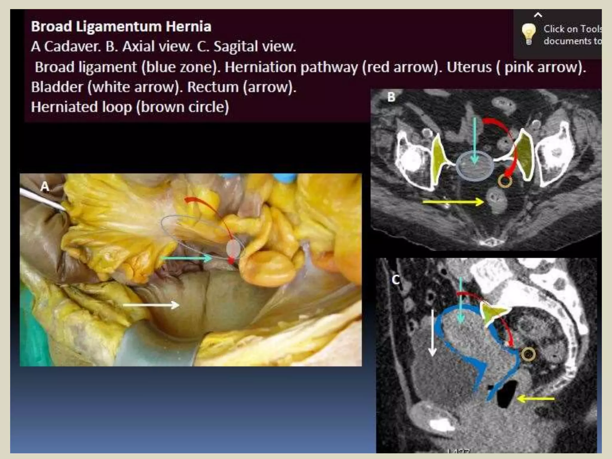 Presentation1, radiological imaging of internal abdominal hernia. | PPTX