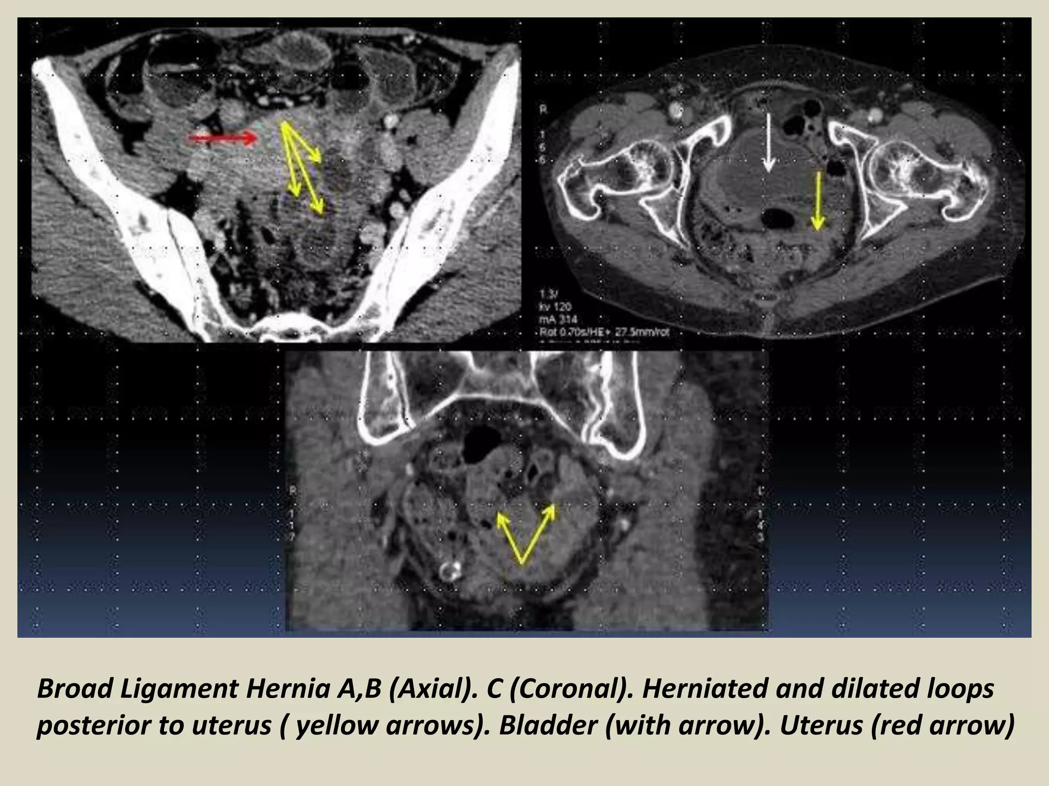 Presentation1, radiological imaging of internal abdominal hernia. | PPTX