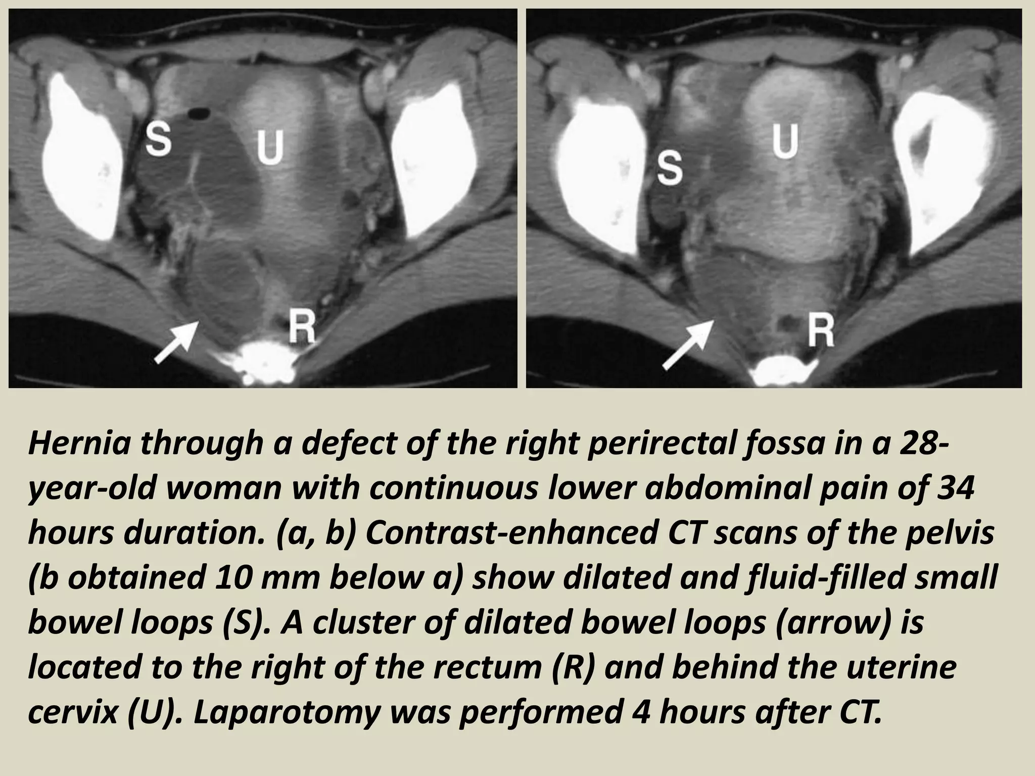 Presentation1, radiological imaging of internal abdominal hernia. | PPTX