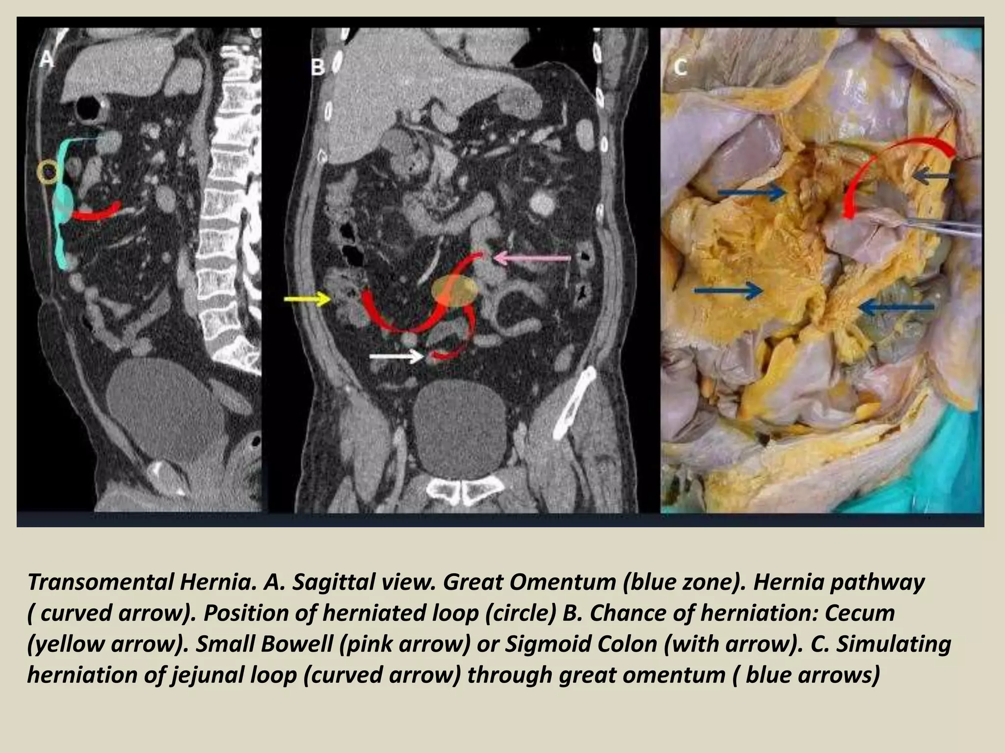 Presentation1, radiological imaging of internal abdominal hernia. | PPTX
