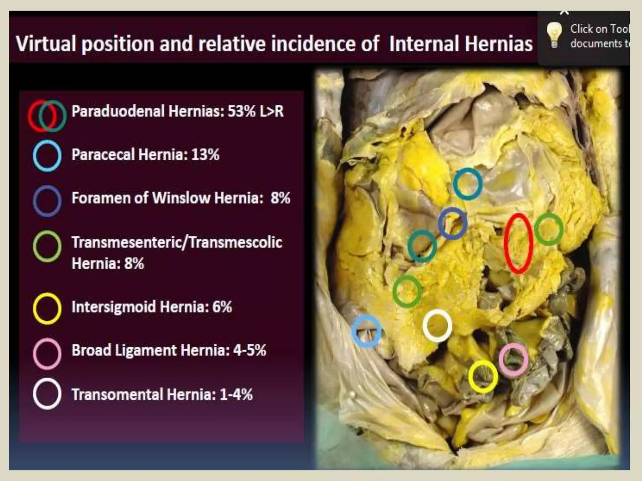 Presentation1, radiological imaging of internal abdominal hernia. | PPTX