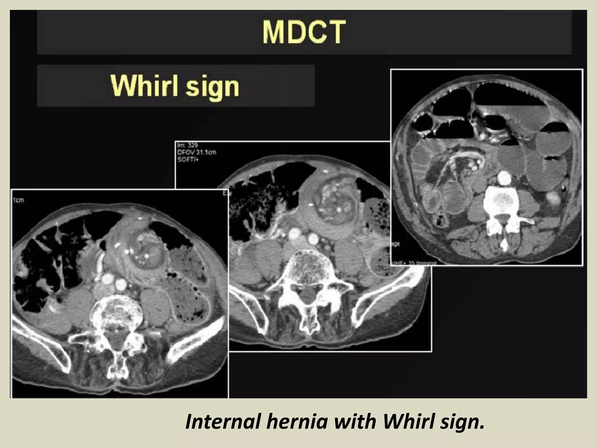 Presentation1, radiological imaging of internal abdominal hernia. | PPTX