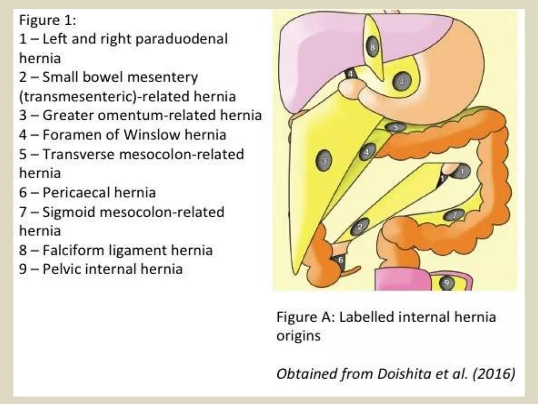 Presentation1, radiological imaging of internal abdominal hernia. | PPTX