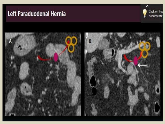 Presentation1, radiological imaging of internal abdominal hernia. | PPTX