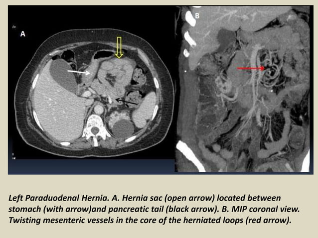 Presentation1, radiological imaging of internal abdominal hernia. | PPTX