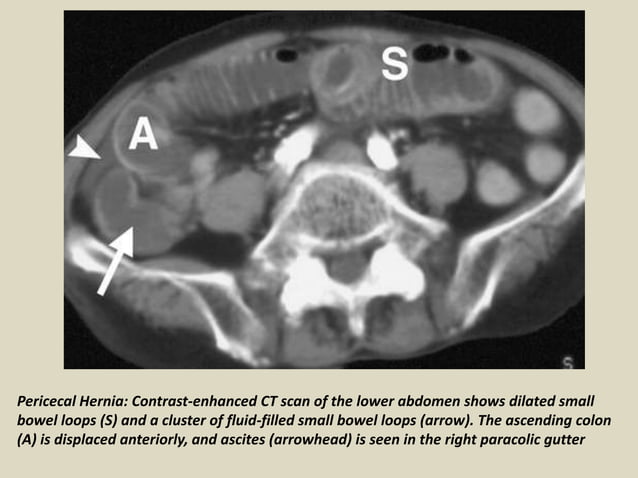 Presentation1, radiological imaging of internal abdominal hernia. | PPTX
