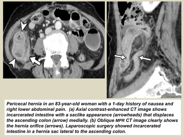 Presentation1, radiological imaging of internal abdominal hernia. | PPTX