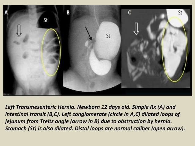 Presentation1, radiological imaging of internal abdominal hernia. | PPT