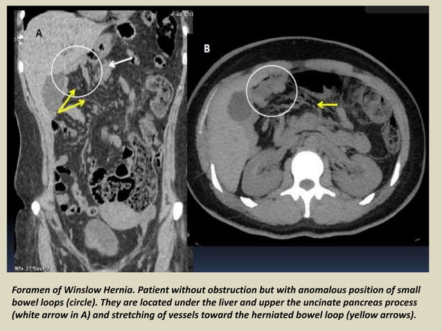 Presentation1, radiological imaging of internal abdominal hernia. | PPTX