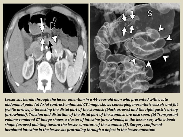 Presentation1, radiological imaging of internal abdominal hernia. | PPTX