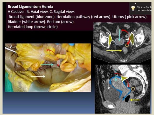 Presentation1, radiological imaging of internal abdominal hernia. | PPTX
