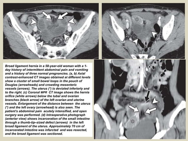 Presentation1, radiological imaging of internal abdominal hernia. | PPTX