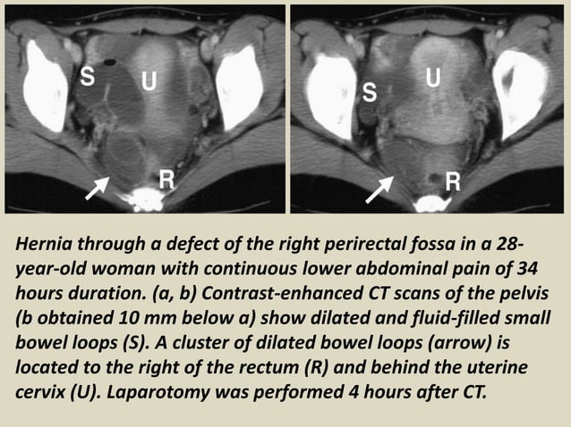 Presentation1, radiological imaging of internal abdominal hernia. | PPTX