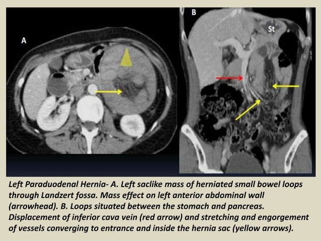 Presentation1, radiological imaging of internal abdominal hernia.