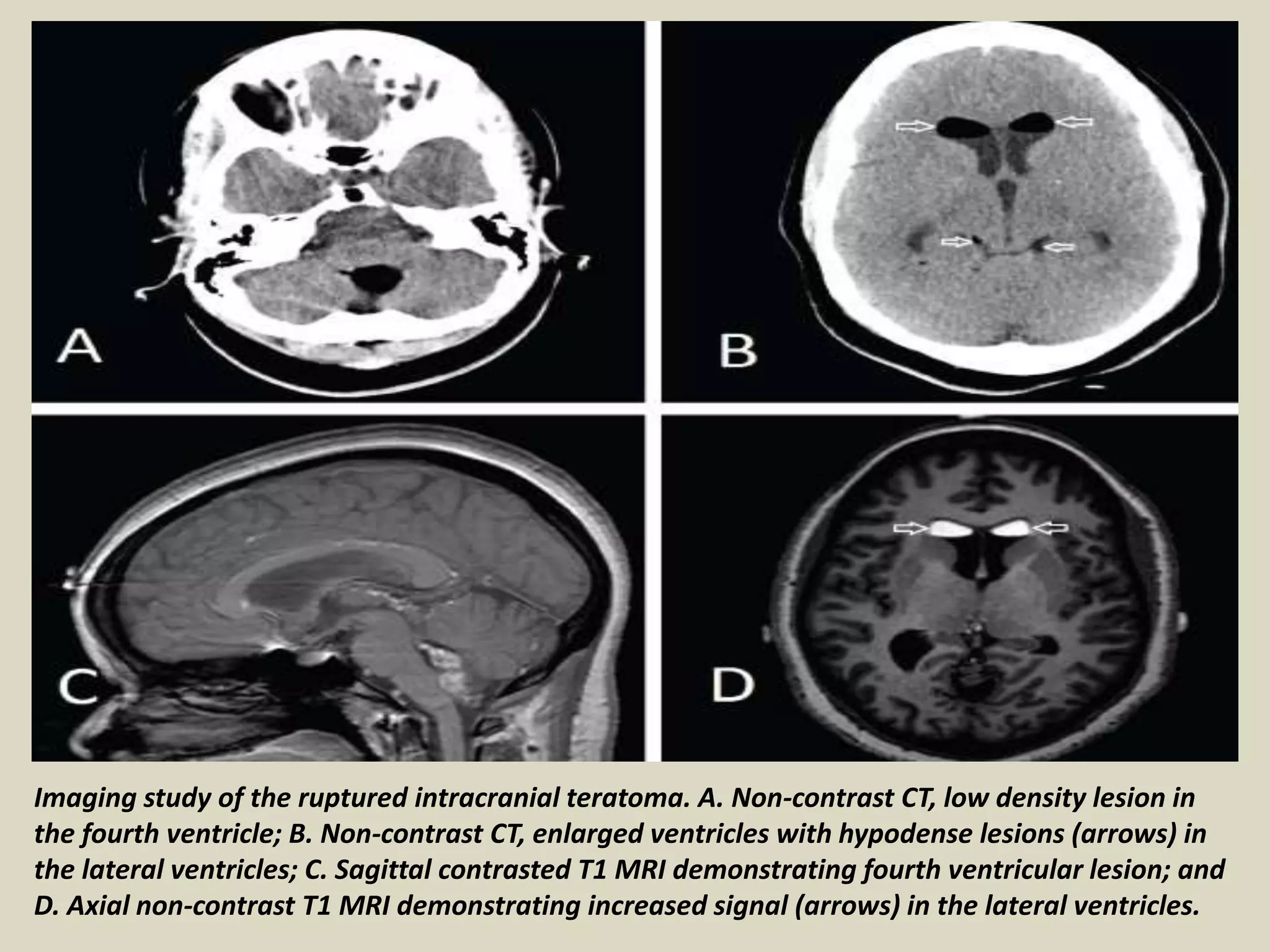 Presentation1, radiological imaging of intra cranial dermoid tumours ...