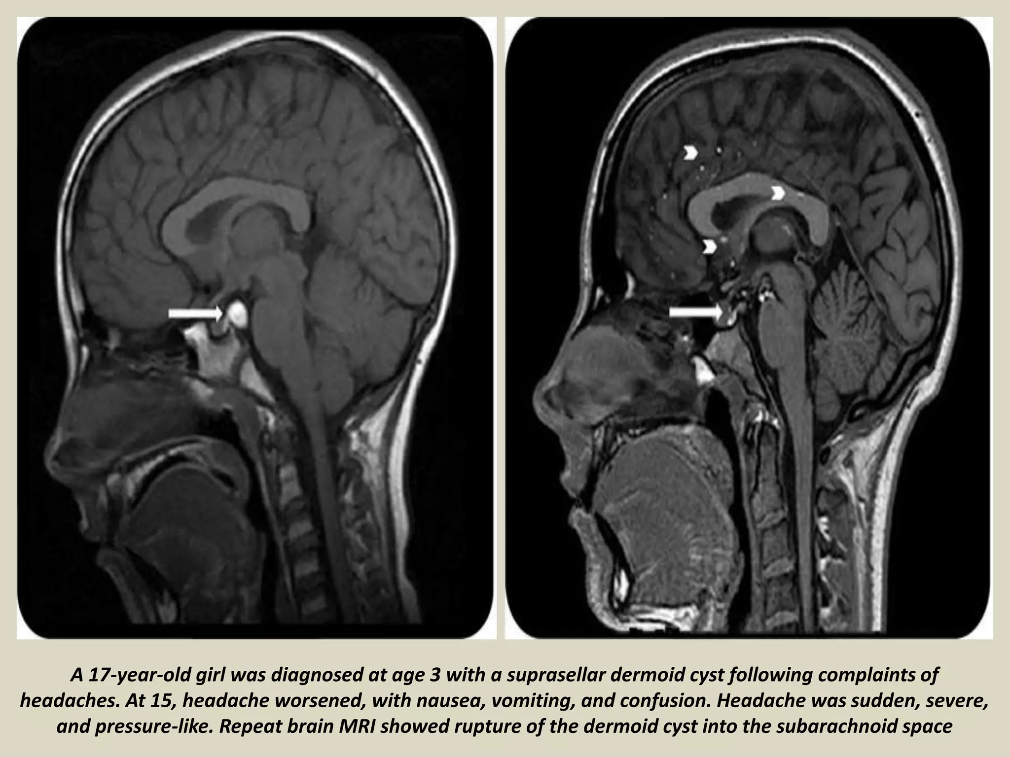 Presentation1, radiological imaging of intra cranial dermoid tumours ...