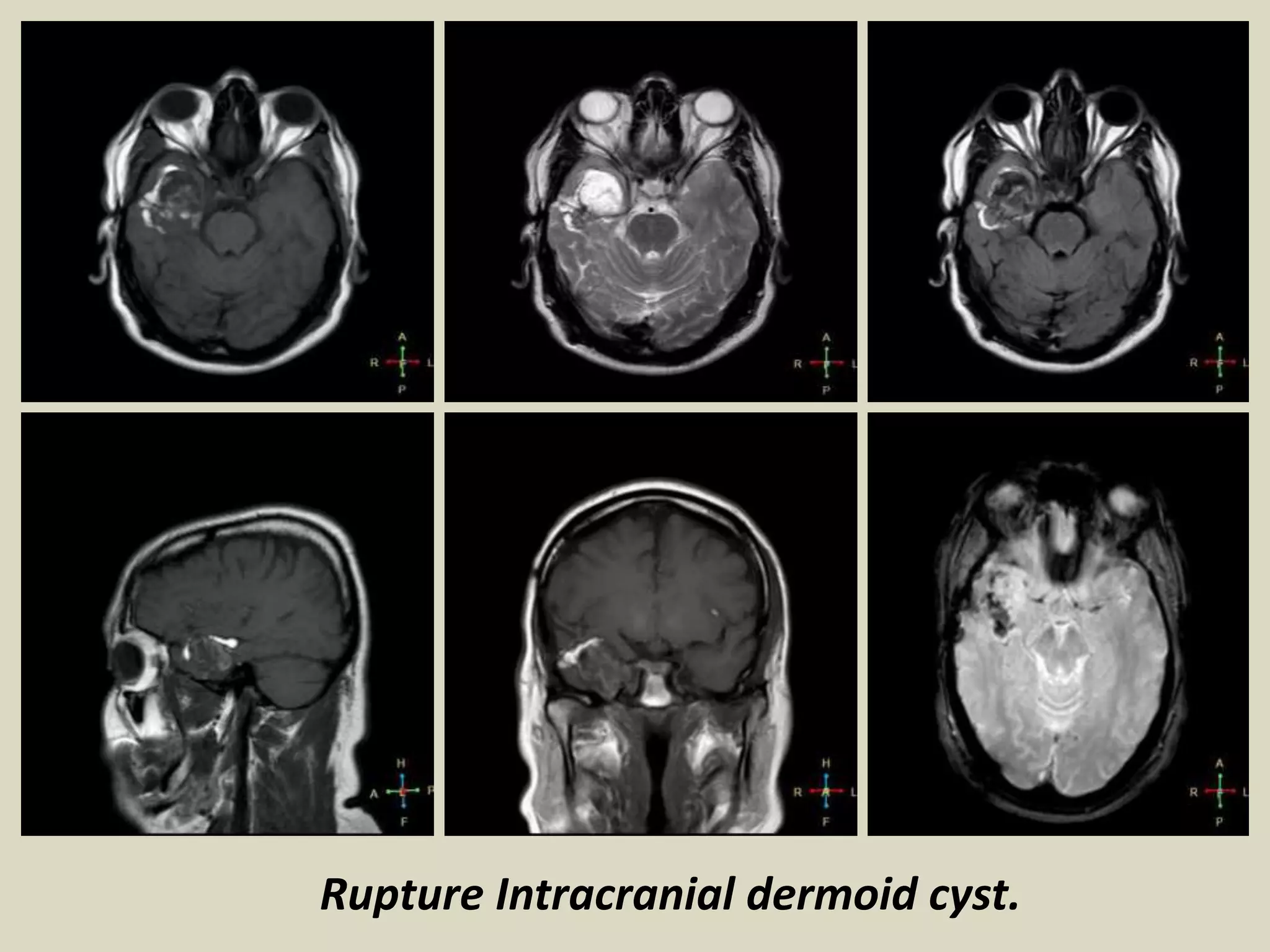 Presentation1, radiological imaging of intra cranial dermoid tumours ...