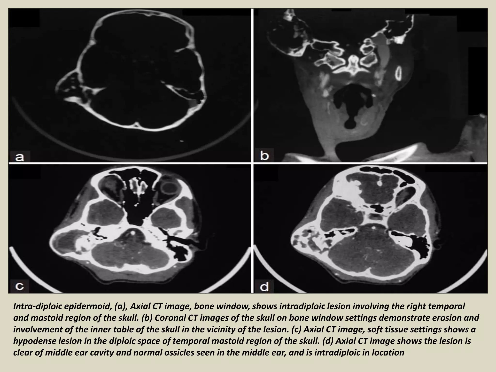 Presentation1, radiological imaging of intra cranial dermoid tumours ...