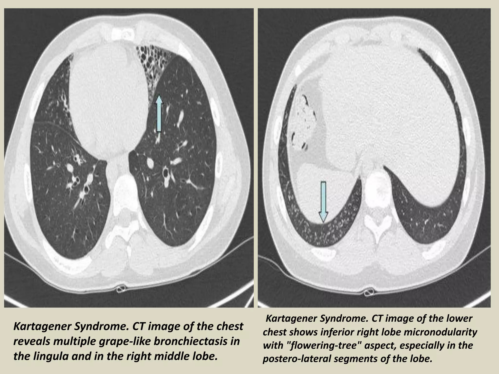 Presentation1, radiological imaging of karrtegner,s syndrome. | PPTX