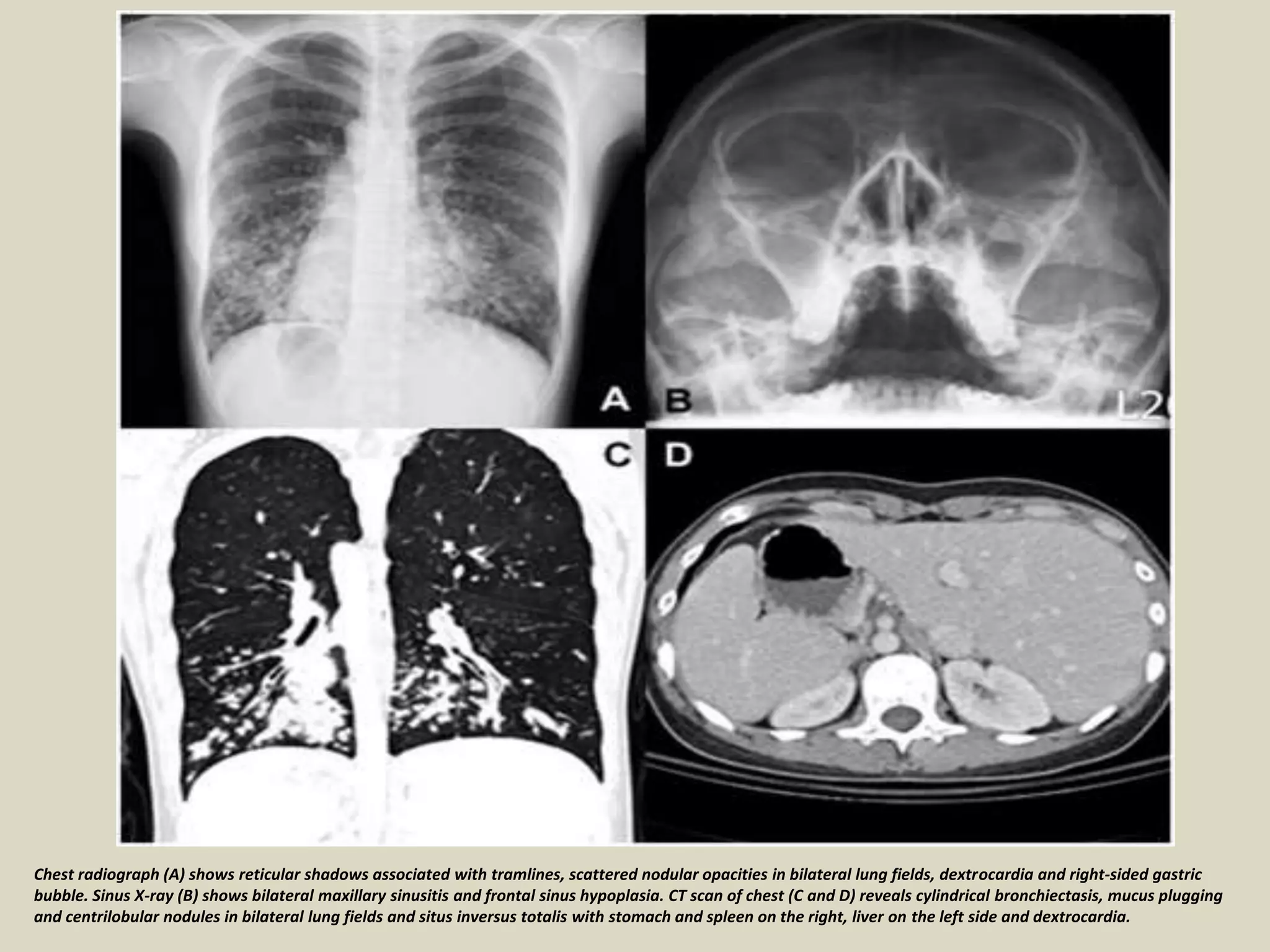 Presentation1, radiological imaging of karrtegner,s syndrome. | PPTX