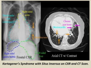 Presentation1, radiological imaging of karrtegner,s syndrome. | PPTX