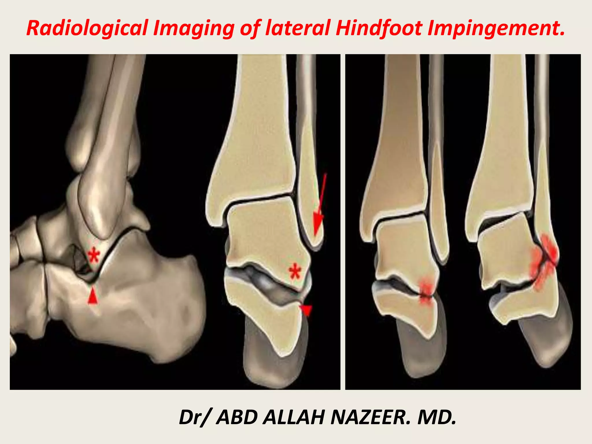 Presentation1, radiological imaging of lateral hindfoot impingement. | PPTX