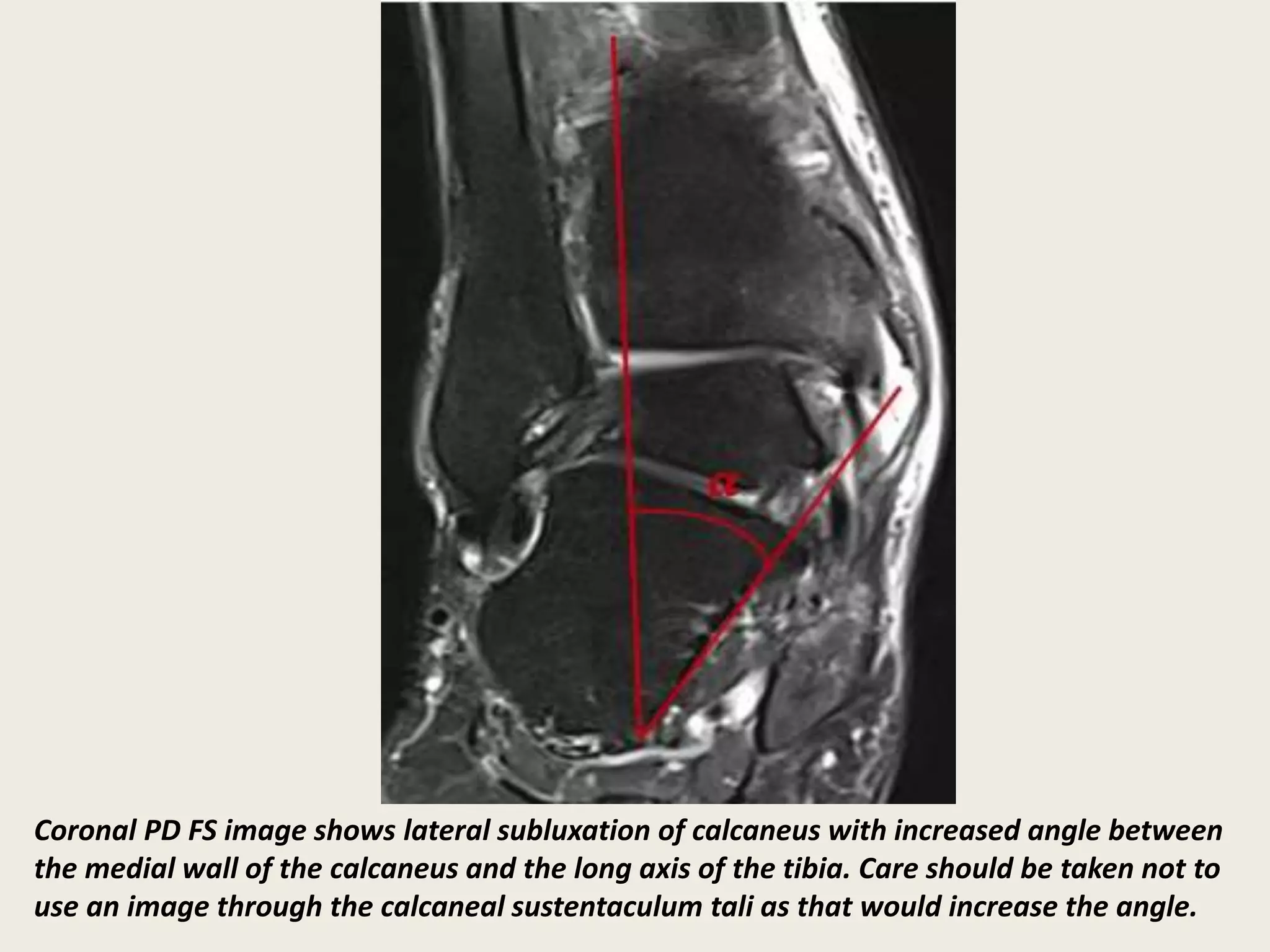 Presentation1, radiological imaging of lateral hindfoot impingement. | PPTX