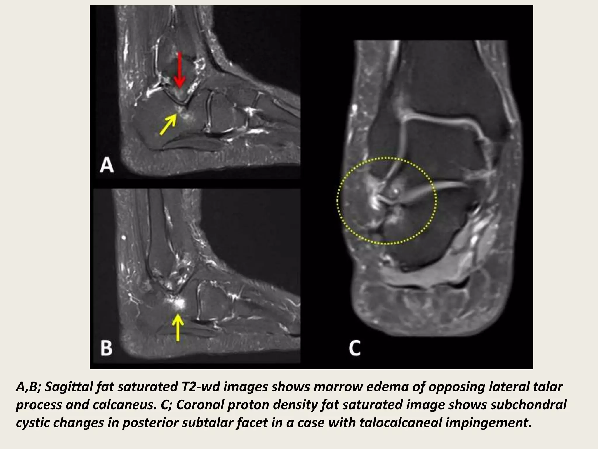 Presentation1, radiological imaging of lateral hindfoot impingement. | PPTX
