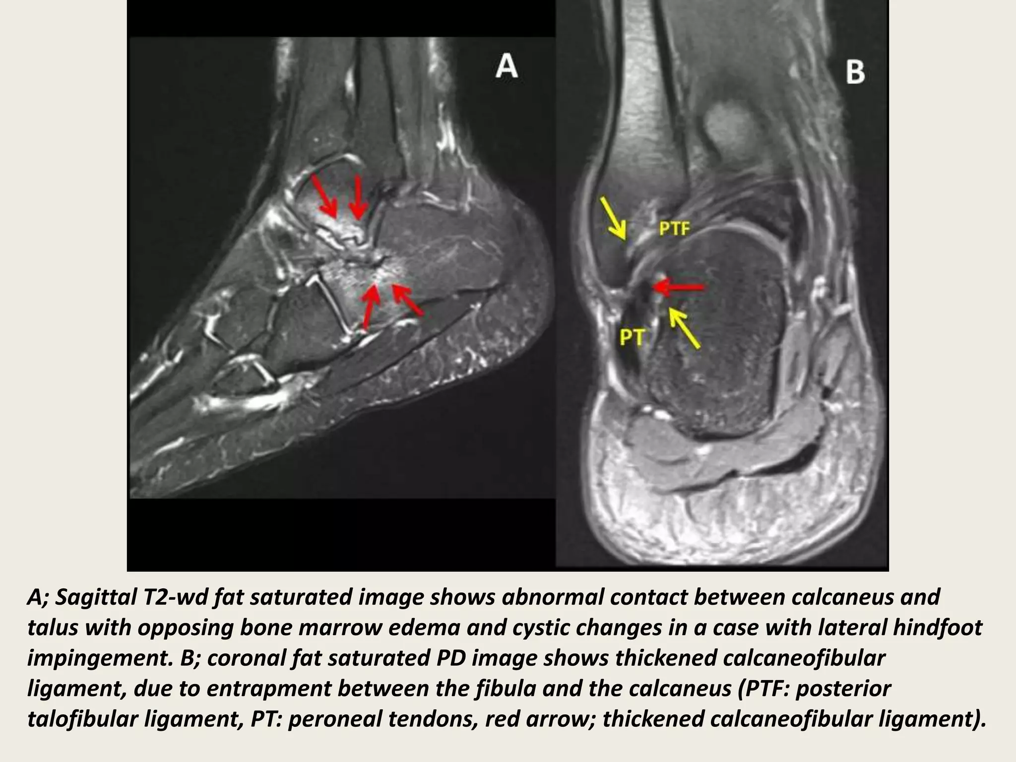 Presentation1, radiological imaging of lateral hindfoot impingement. | PPTX
