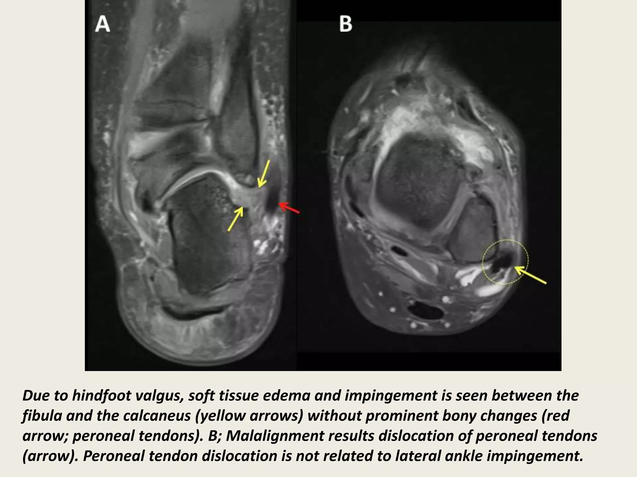 Presentation1, radiological imaging of lateral hindfoot impingement. | PPTX