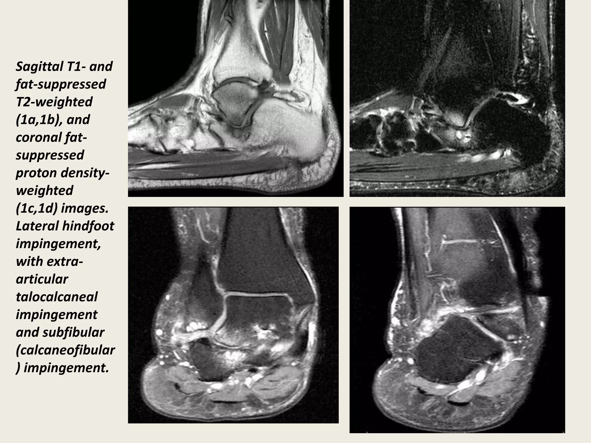 Presentation1, radiological imaging of lateral hindfoot impingement. | PPTX