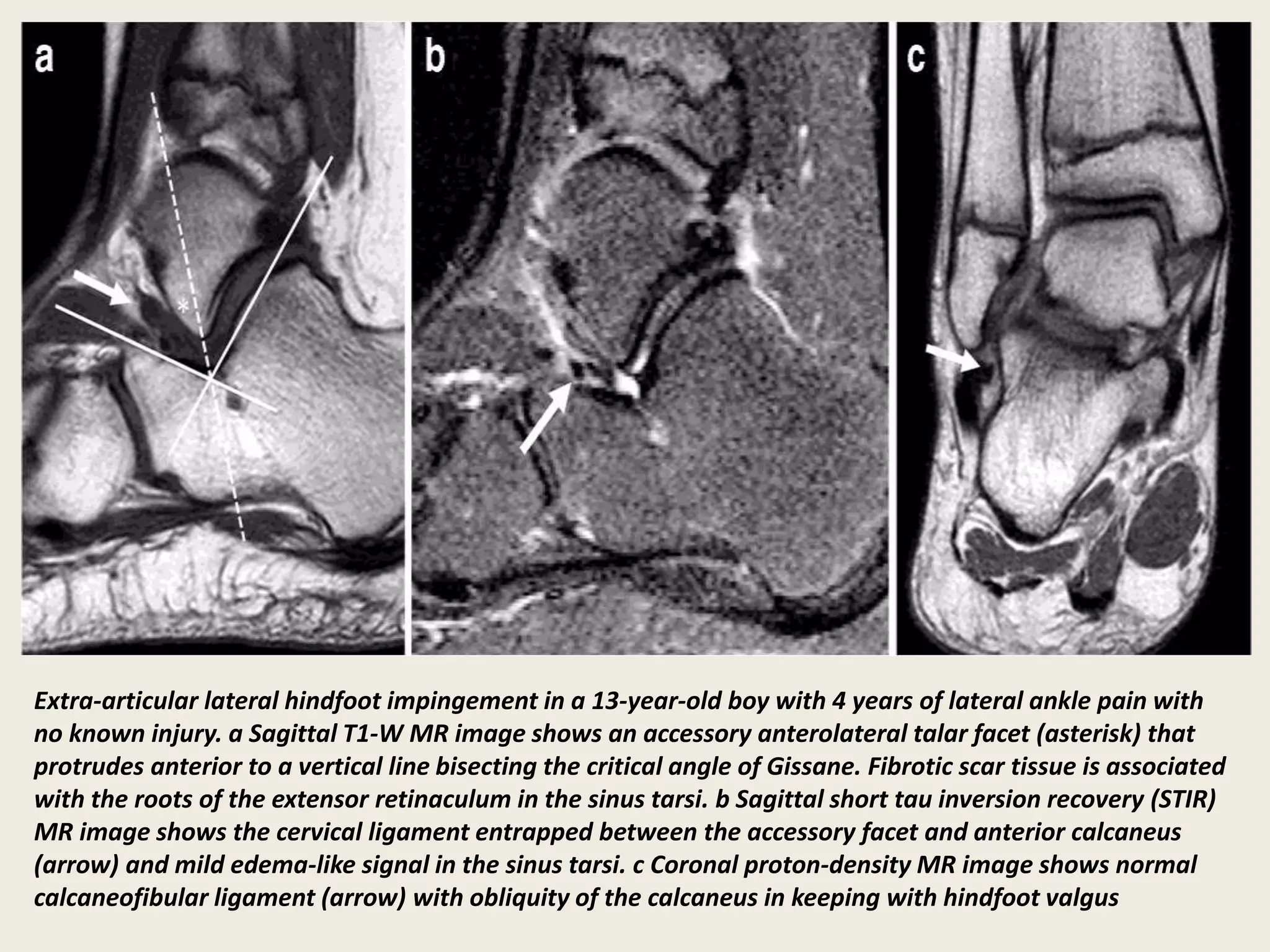 Presentation1, radiological imaging of lateral hindfoot impingement. | PPTX