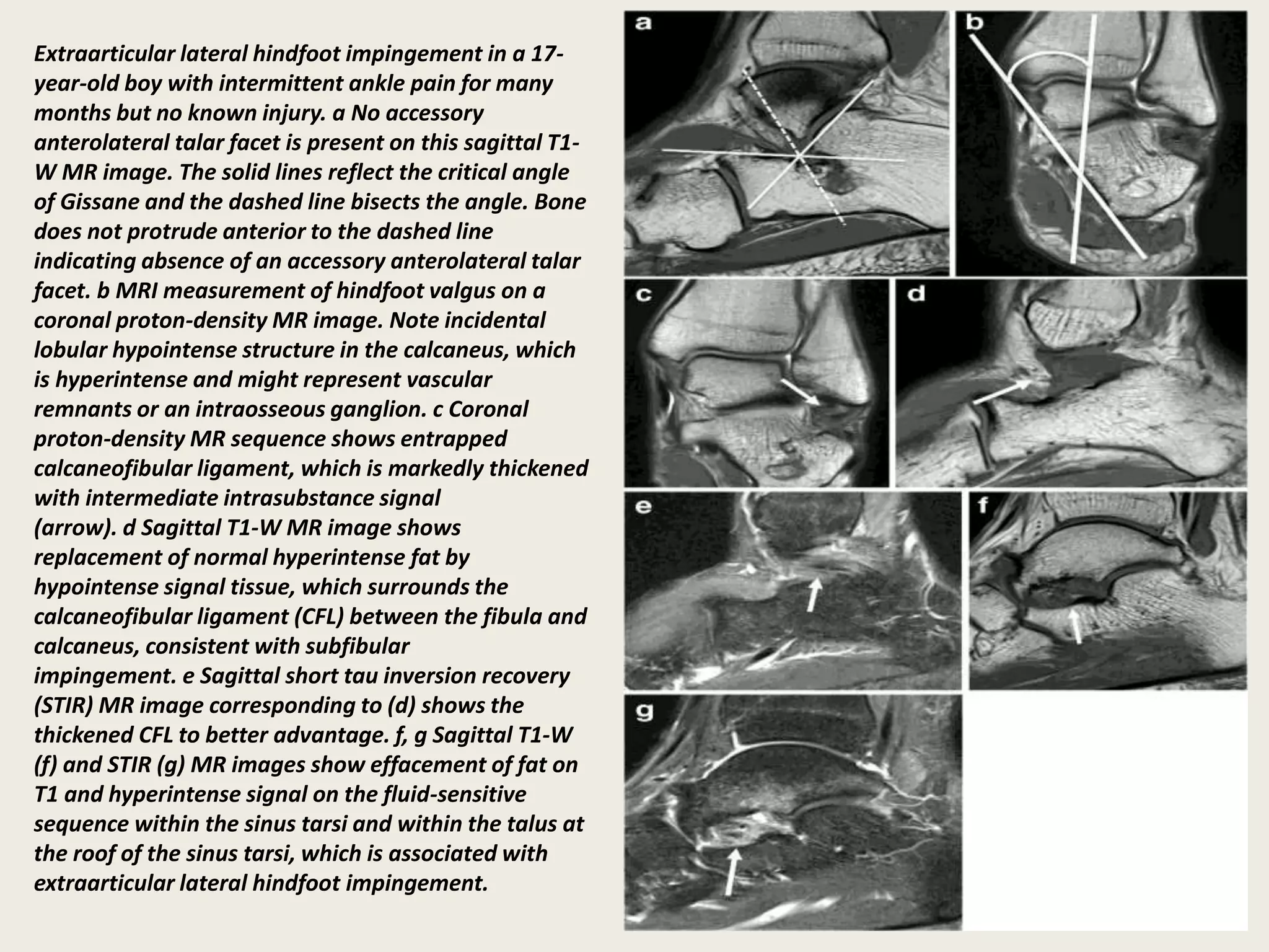 Presentation1, radiological imaging of lateral hindfoot impingement. | PPTX