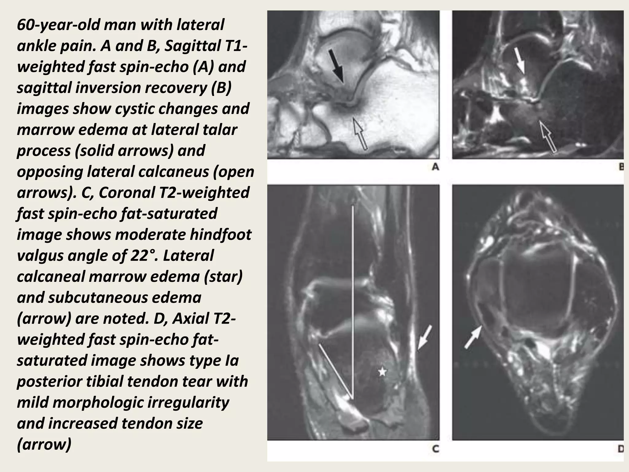 Presentation1, radiological imaging of lateral hindfoot impingement. | PPTX