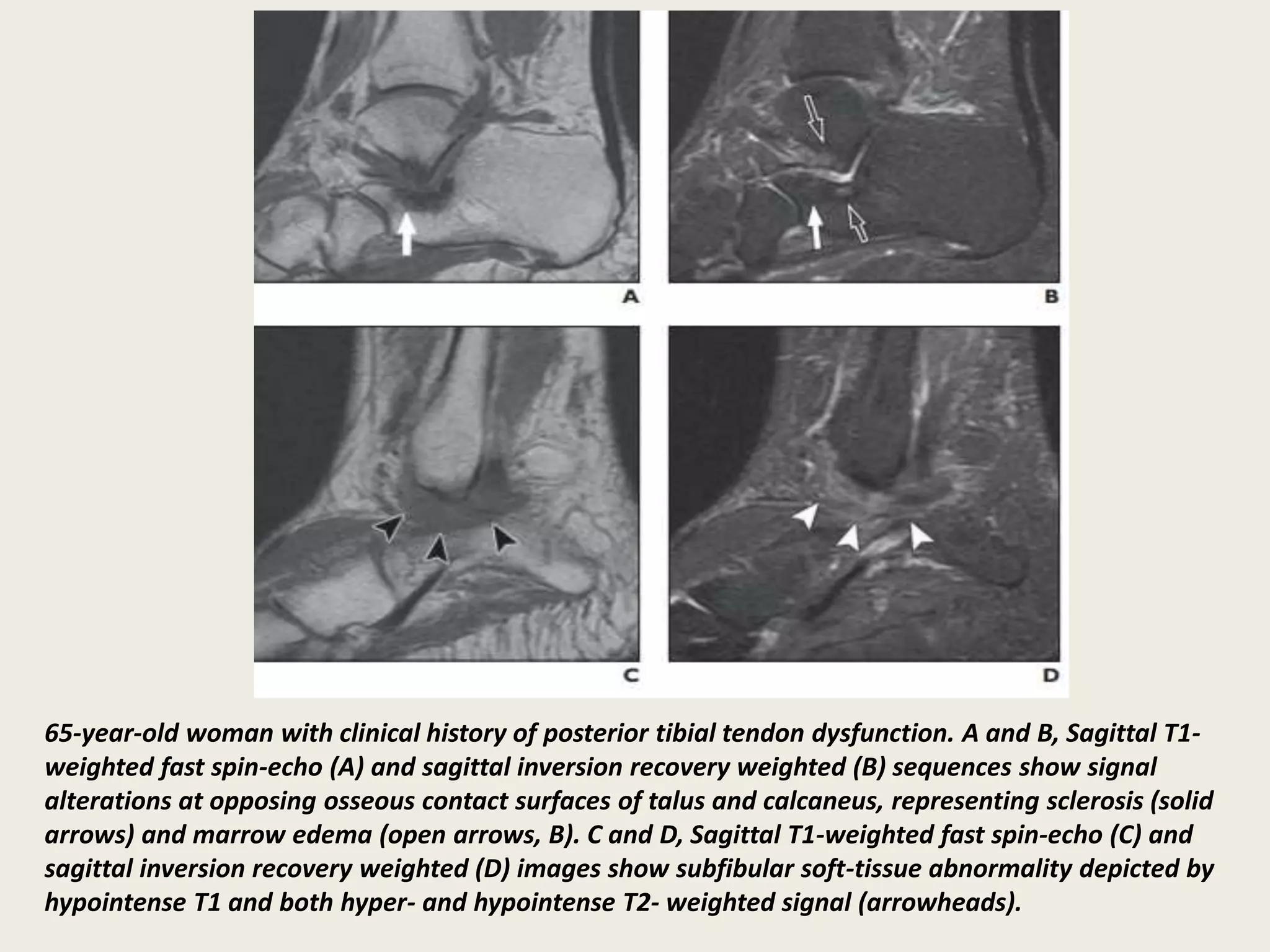 Presentation1, radiological imaging of lateral hindfoot impingement. | PPTX