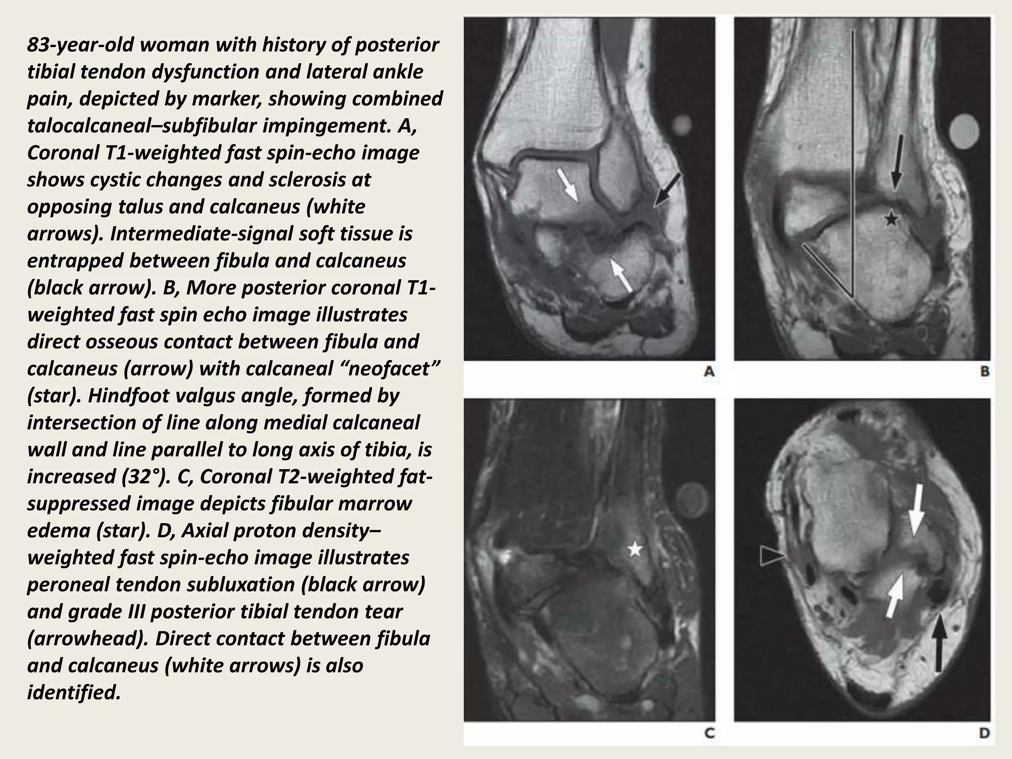 Presentation1, radiological imaging of lateral hindfoot impingement. | PPTX