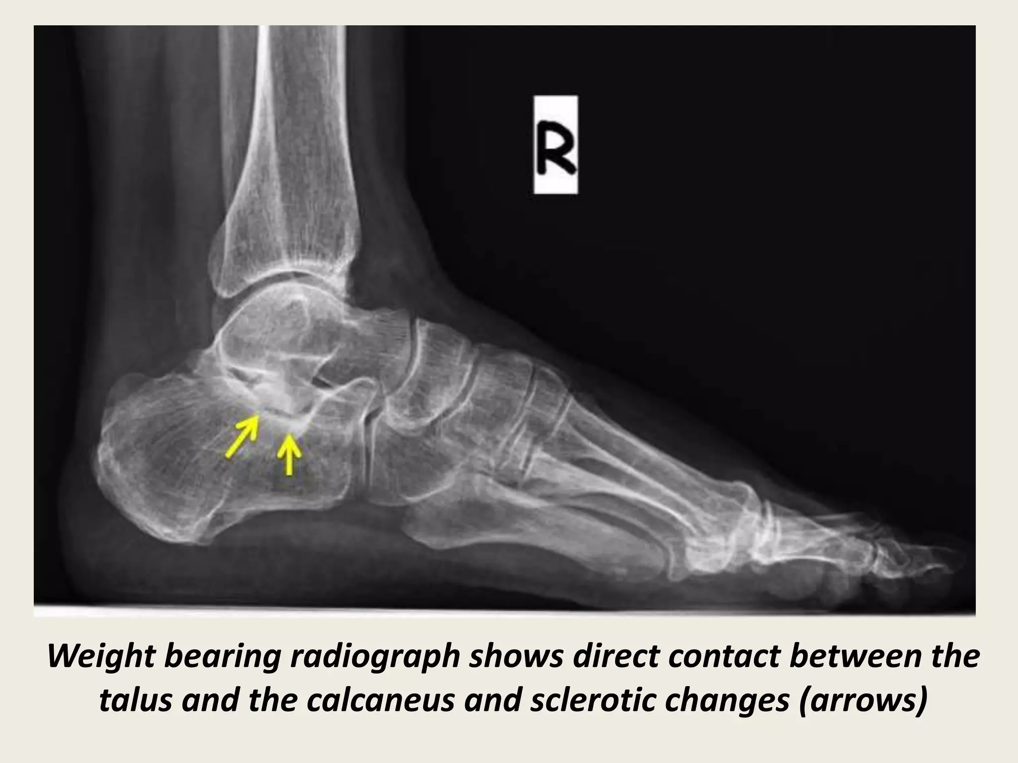 Presentation1, radiological imaging of lateral hindfoot impingement. | PPTX