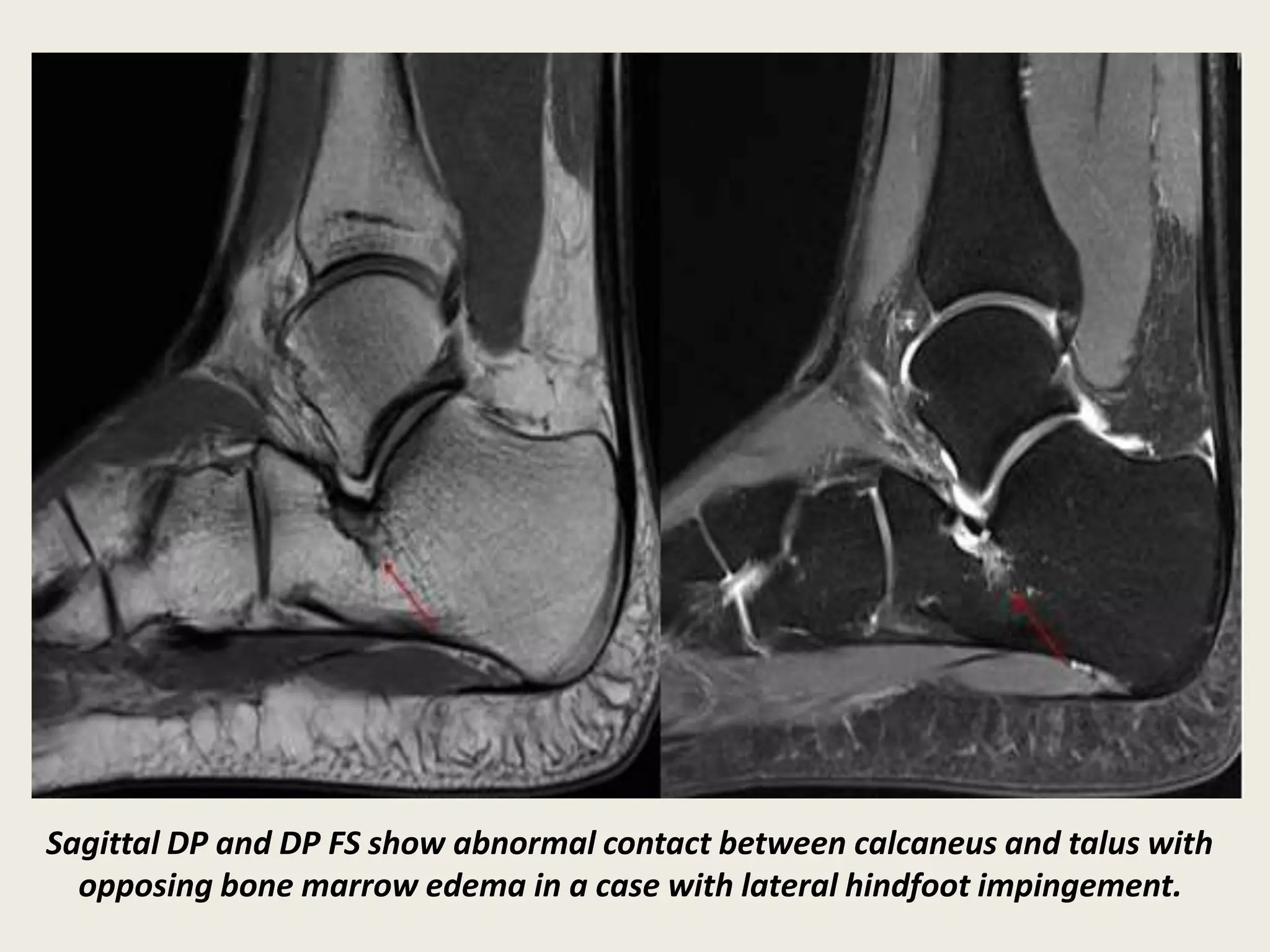 Presentation1, radiological imaging of lateral hindfoot impingement. | PPTX