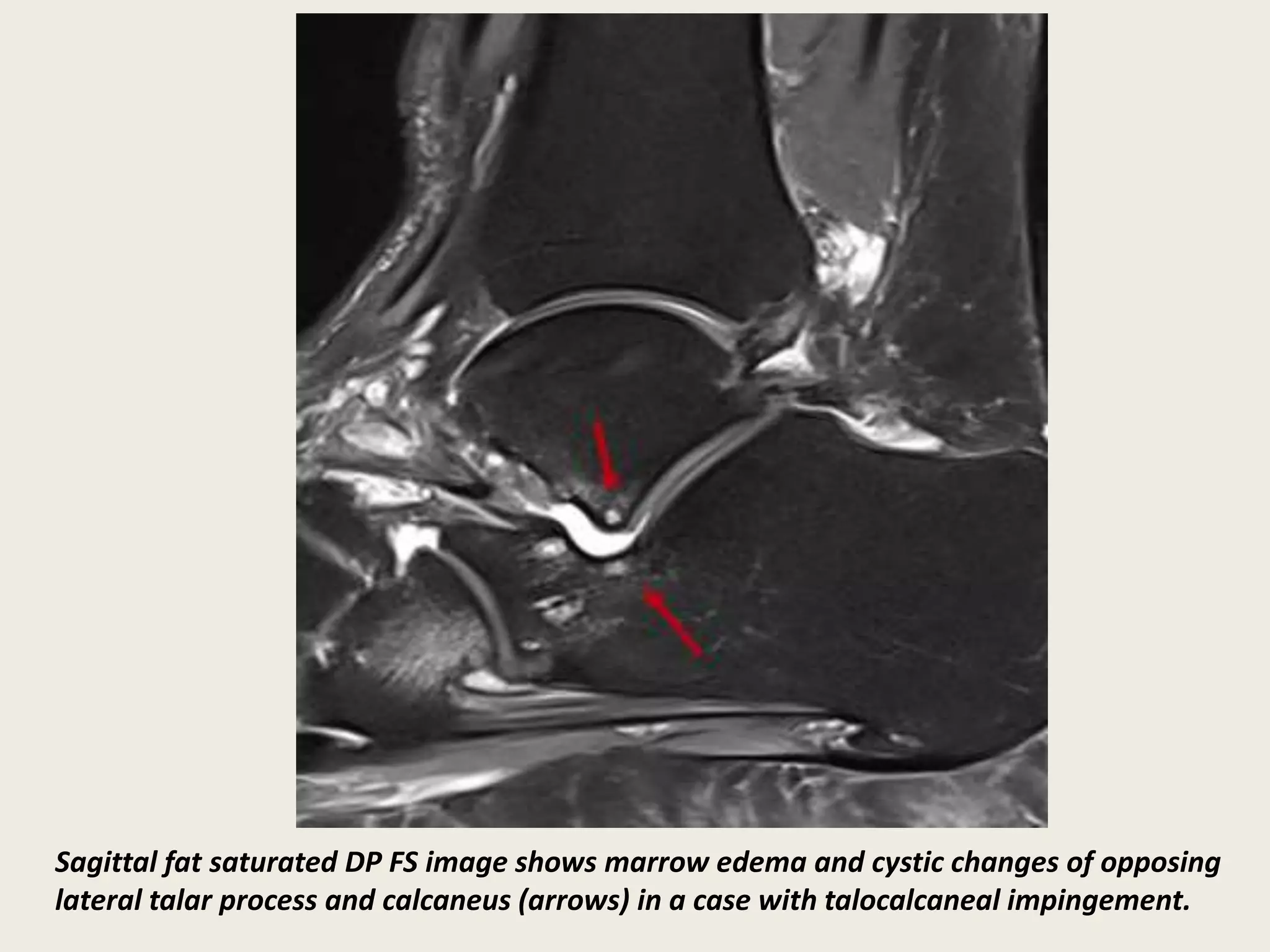 Presentation1, radiological imaging of lateral hindfoot impingement. | PPTX