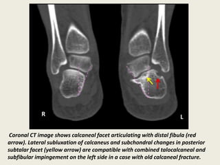 Presentation1, radiological imaging of lateral hindfoot impingement. | PPTX
