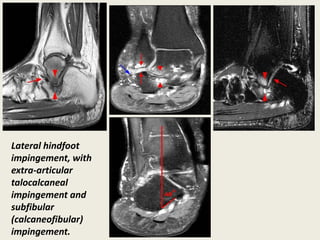 Presentation1, radiological imaging of lateral hindfoot impingement. | PPTX