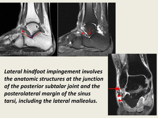 Presentation1, radiological imaging of lateral hindfoot impingement. | PPTX