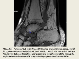 Presentation1, radiological imaging of lateral hindfoot impingement. | PPTX