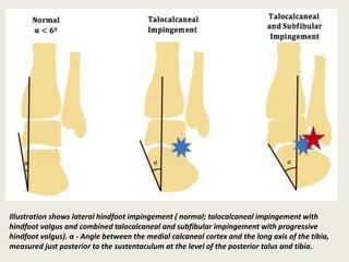 Presentation1, radiological imaging of lateral hindfoot impingement. | PPTX