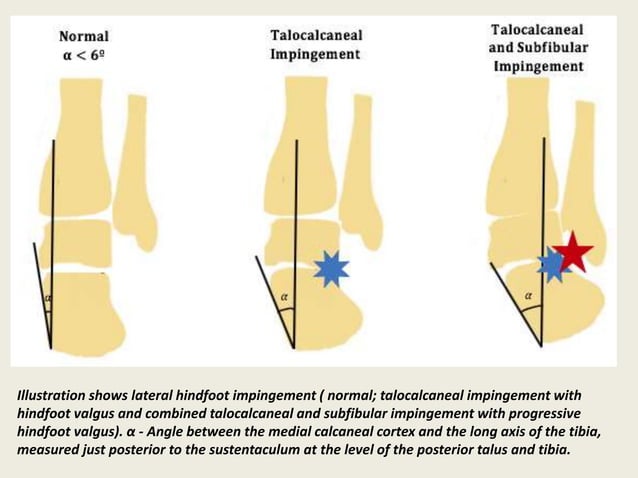 Presentation1, radiological imaging of lateral hindfoot impingement. | PPT